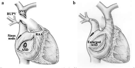Figure 2 From Congenital Pulmonary Vein Stenosis With Anomalous Pulmonary Venous Connection