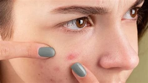 Say Goodbye To Pimples With These Skincare Tips To Get Flawless Skin During Summer Beauty News