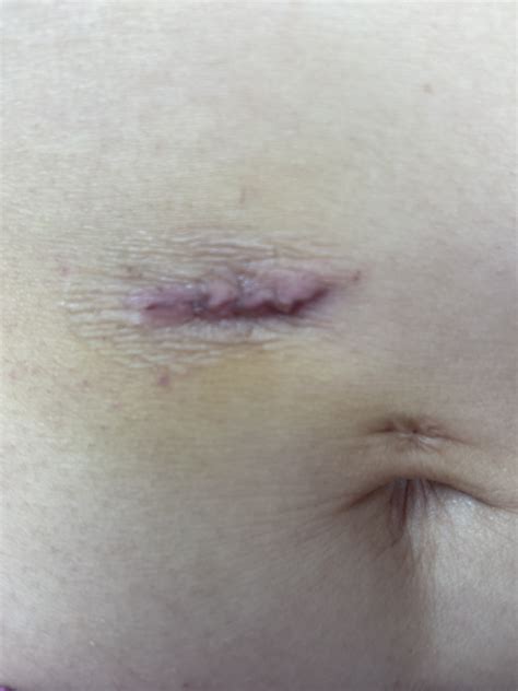 Infected Laparoscopic Incision