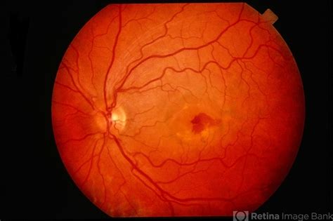 Reticular Pattern Dystrophy Retina Image Bank