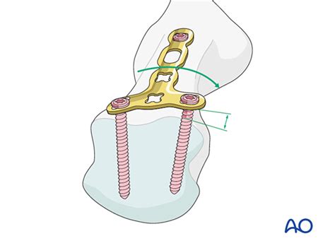 Compression Plating For Extraarticular Fracture Of The Distal End Segment