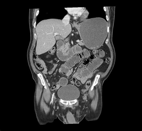 Ct Of The Abdomen And Pelvis Showing Evidence Of Small Bowel Download Scientific Diagram