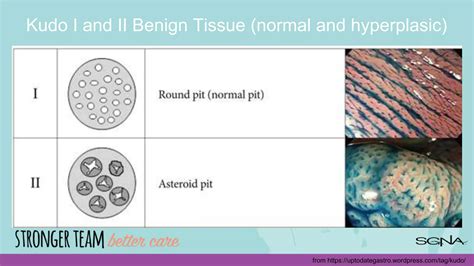 Kudos To You Learning Your Kudo Pit Patterns And Paris Polyp
