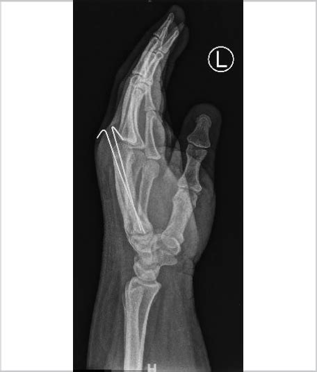 38 Metacarpal Fracture Open Reduction And Internal Fixation Orif