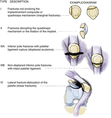 Fractures Of The Patella Musculoskeletal Key