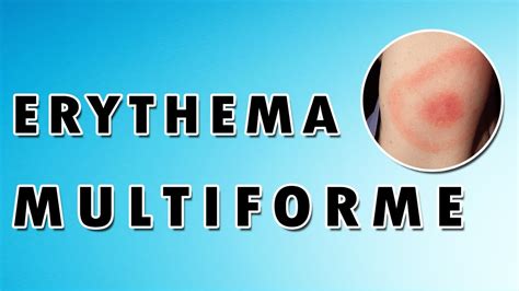 Erythema Migrans Images