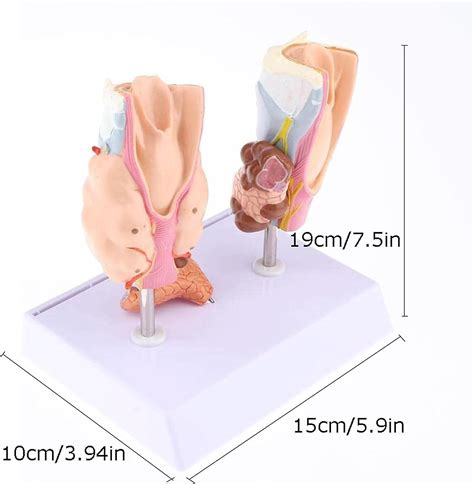 Human Thyroid Pathology Model Anatomical Thyroid Lesion Model For Doctor Patient Communication