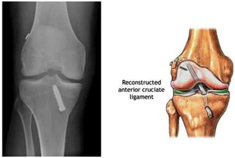 ACL Reconstruction Dr Peter DAlessandro Orthopaedic Surgeon Claremont WA