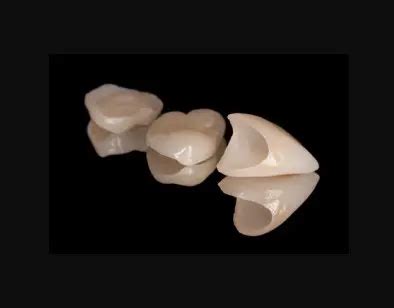 Veneers