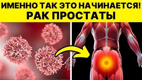 7 Ранних Признаков Рака Простаты Которые Должен Знать Каждый Мужчина Youtube
