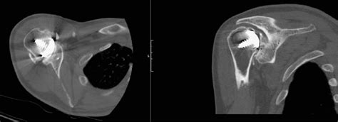 Computed Tomography Scan Of A Patient 39 Months After Partial