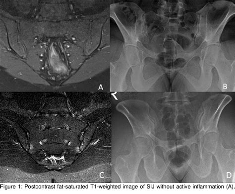 Figure 1 From Jointnet A Deep Model For Predicting Active Sacroiliitis From Sacroiliac Joint