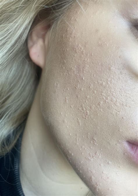[misc] Weird Spots Or Texture On Skin R Skincareaddiction