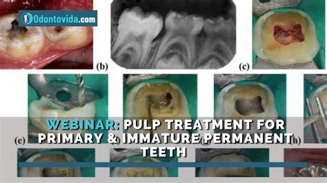 Webinar Pulp Treatment For Primary And Immature Permanent Teeth Dr