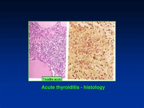 Ppt Thyroiditis Powerpoint Presentation Free Download Id 3635117