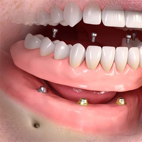 Implant Retained Dentures Taunton Dentures Taunton False Teeth