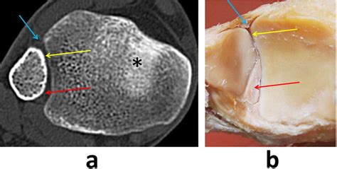 Anatomy Of The Distal Tibiofibular Contact A Transverse Ct Scan B Download Scientific Diagram