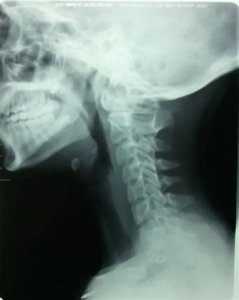 Columna Cervical Normal De Interpretación Radiológica Doctor Online