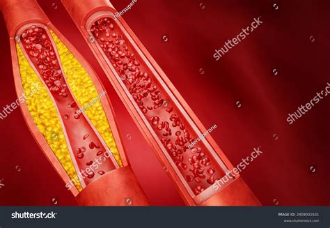Hyperlipidemia Arteriosclerosis Blocked Artery Concept Human Stock