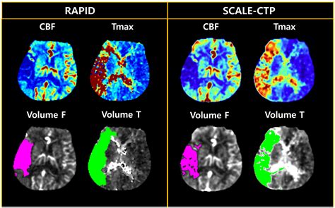 A Comparative Analysis Of Scale Ctp And Rapid In Determining The