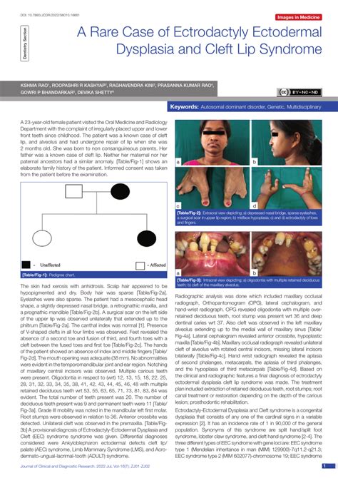 Pdf A Rare Case Of Ectrodactyly Ectodermal Dysplasia And Cleft Lip Syndrome