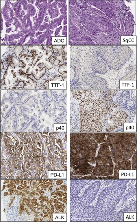 Lung Cancer Biomarkers Oncohema Key Lung Cancer Biomarkers Oncohema Key
