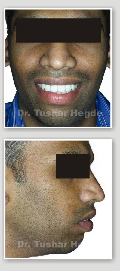 Dental Protrusion Smile With Braces