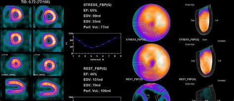 Myocardial Perfusion Scan I Med Radiology Network