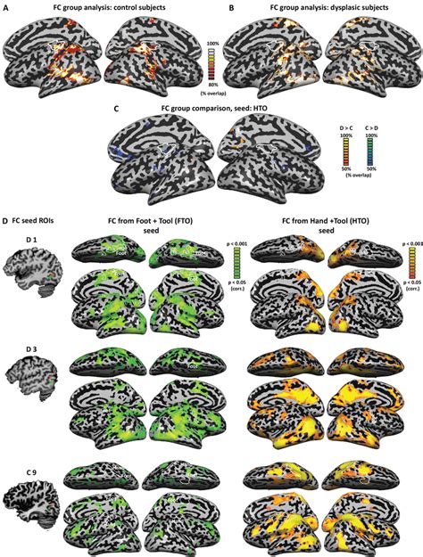 Connectivity From The Occipito Temporal Cortex Reflects Intact Visual