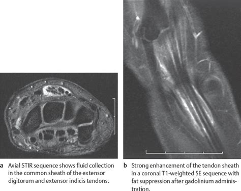 Extensor Pollicis Longus Mri Extensor Pollicis Longus Mri