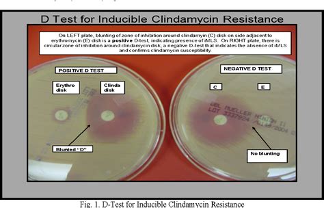Labcorp Mrsa Screening At Harold Case Blog