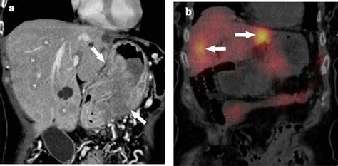 Type 3 Gastric Neuroendocrine Tumor A Coronal Contrast Enhanced Ct