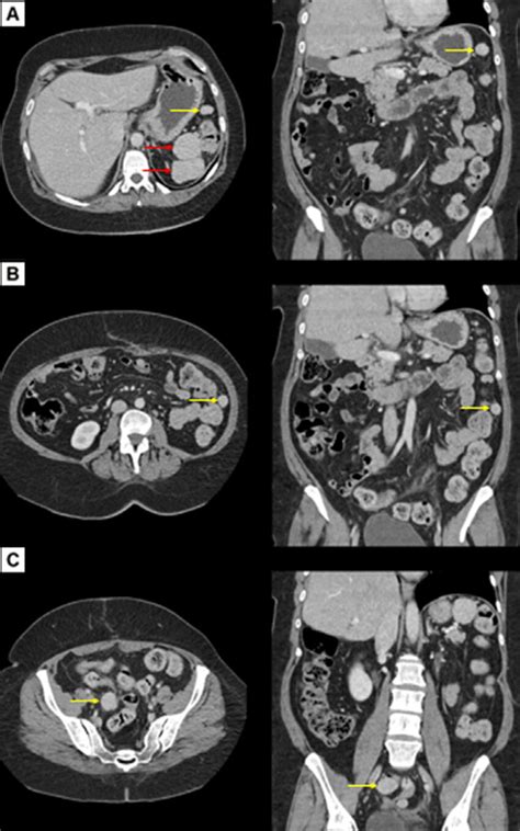 Abdominal And Pelvic Ct Superior A Intermedium B And Inferior Download Scientific
