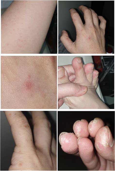 Viral Exanthem Differential