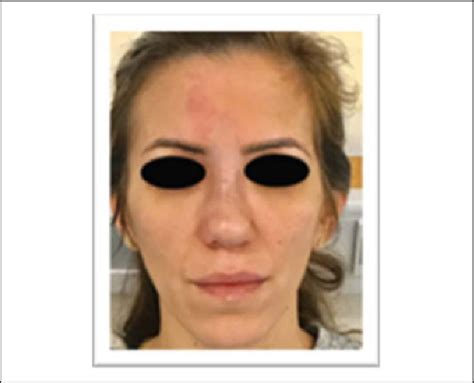 Tissue Ischemia Corresponding To Arterial Distribution A 33 Year Old Download Scientific