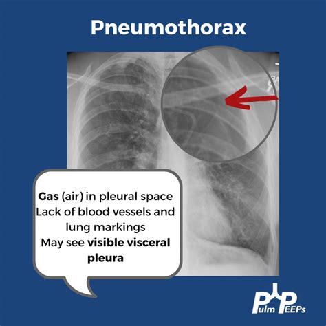 Pneumothorax Pulmpeeps
