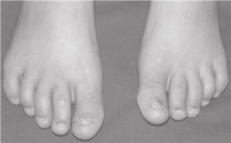 Longitudinal Ridging Accompanied By Distal Dystrophy Of The Nails