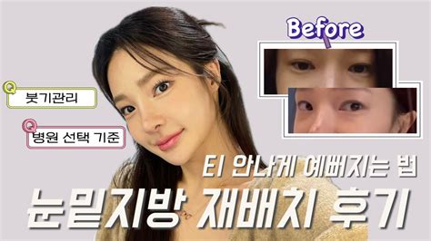 눈밑지방 재배치 추천ㅣ 상담부터 2주차 후기ㅣ하루하루 변화되는 모습 다 보여드려요😂 Youtube