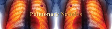 Pulmonary Nodules International Centre For Thoracic Surgery