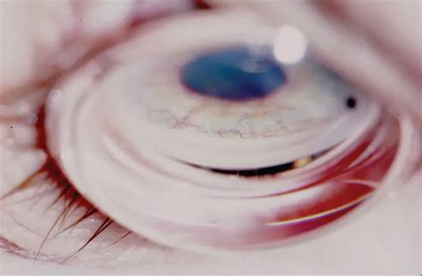 Iris Neovascularization American Academy Of Ophthalmology