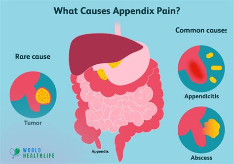 Appendicitis Symptoms Causes Effect And Treatment