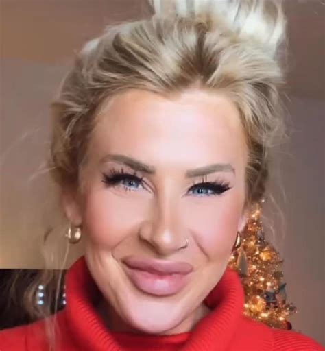 An “influencers” Overfilled Lips Have Their Own Lumps R Botchedsurgeries