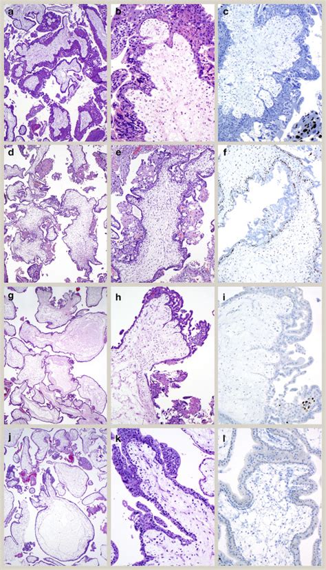 Hydatidiform Moles Differential Diagnosis Diagnostic Reproducibility
