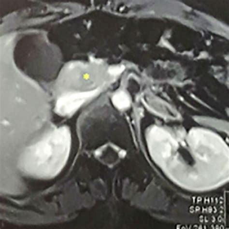 Mri Abdomen Revealed A Hypointense Irregular Mass Yellow Starred In