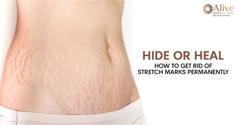 How To Get Rid Of Stretch Marks Permanently With Morpheus8