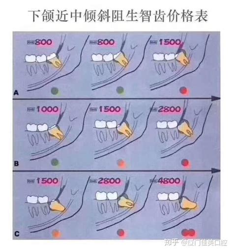 拔智齿收费为啥差别这么大？看了这3张图你就明白了！ 知乎