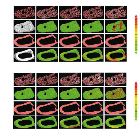 Accuracy Of Trabecular Top And Cortical Bottom Bone Segmentation On