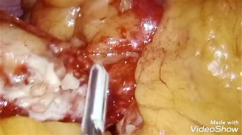 Laparoscopic Appendectomy For Ruptured Appendix At Nol International
