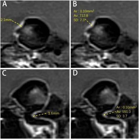 Enhancing Intracranial Aneurysm Rupture Risk Prediction With A Novel Multivariable Logistic
