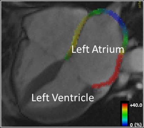 Motion­ Tracking Mri Peers Into The Left Atrium To Evaluate Stroke Risk